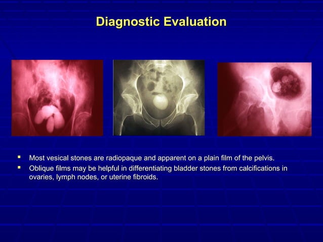 Urinary Stones Disease - Urolithiasis | PPT