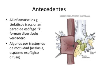 05.diverticulos esofagicos | PPTX