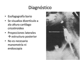 05.diverticulos esofagicos | PPTX