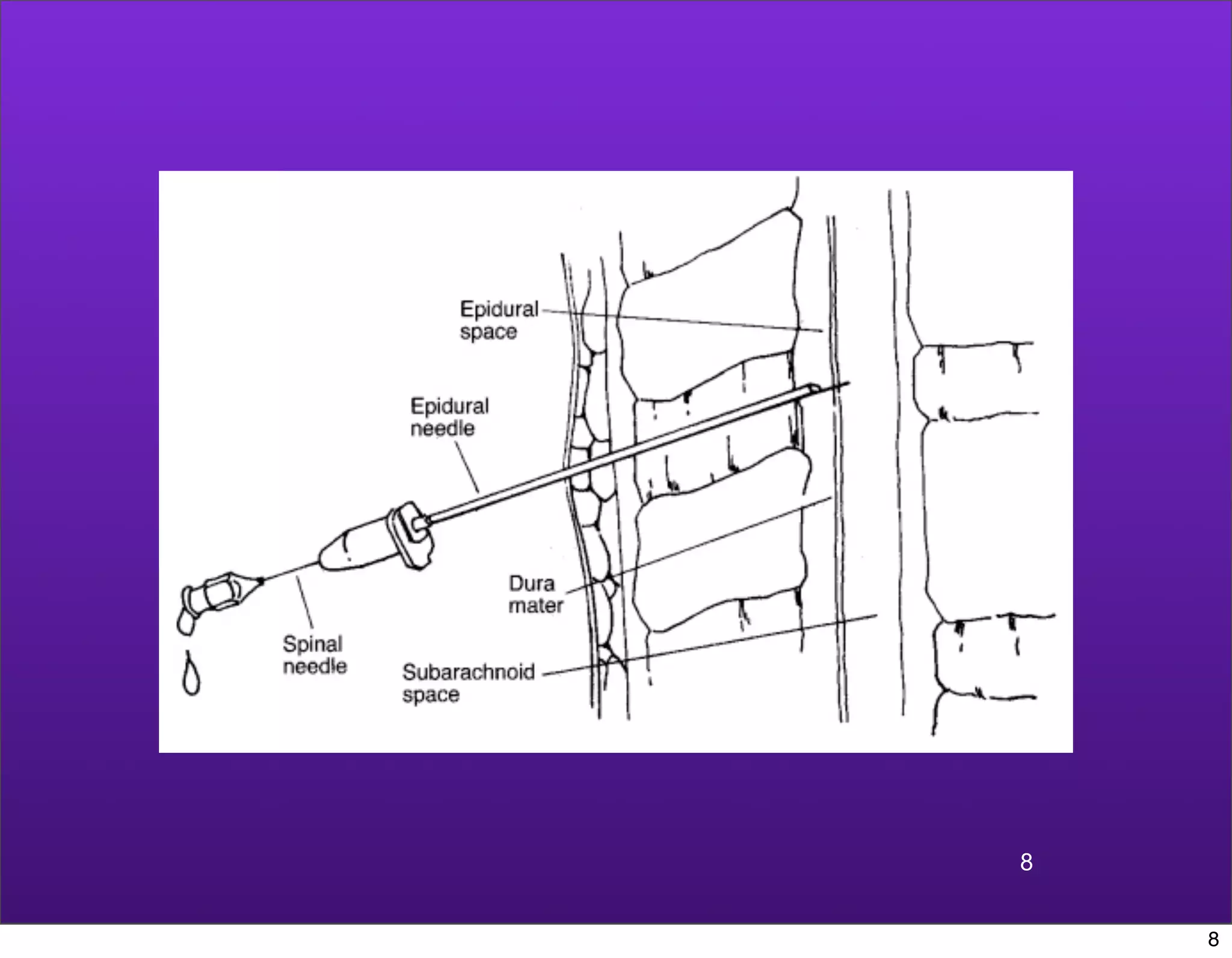 05. anestesia kombinasi spinal epidural cpd 2010 16 slide | PDF