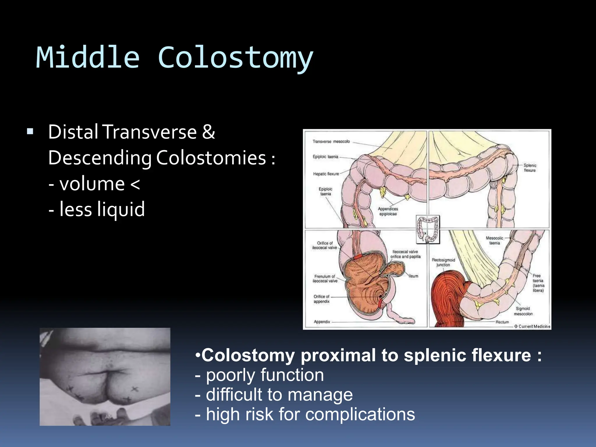 Perawatan luka dan stoma pada pasien post colostomy.ppt