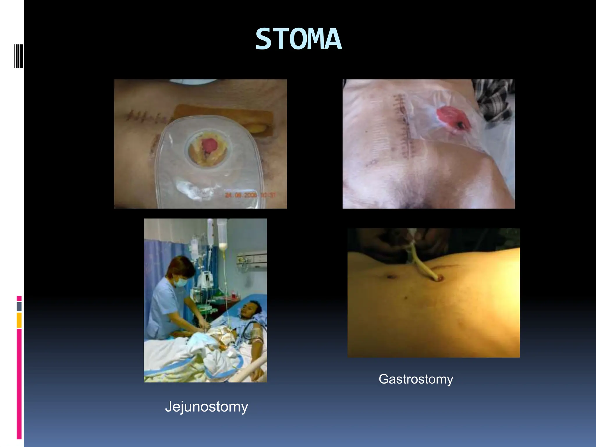 Perawatan luka dan stoma pada pasien post colostomy.ppt