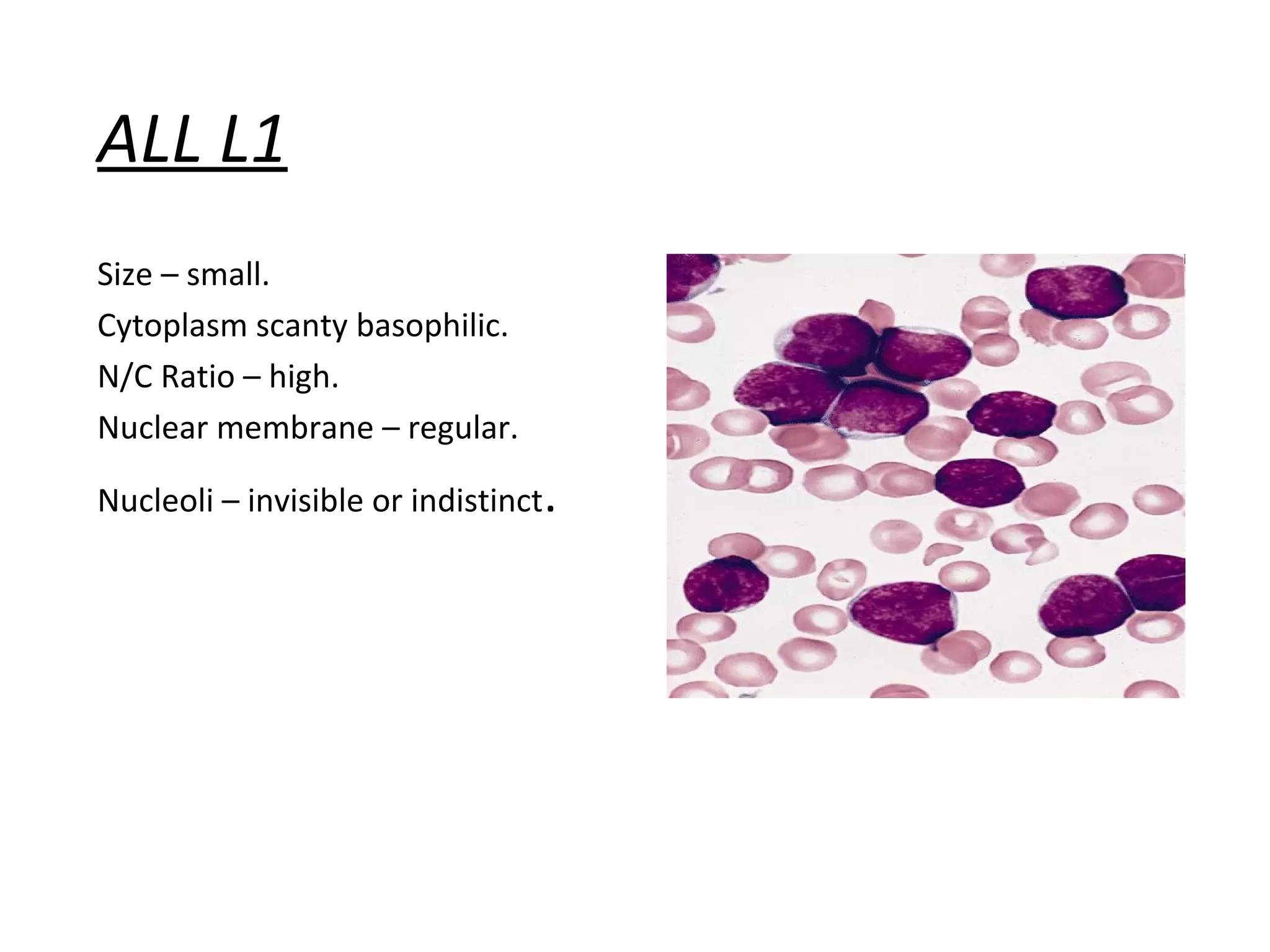 Acute Lymphoblastic Leukemia | PPT