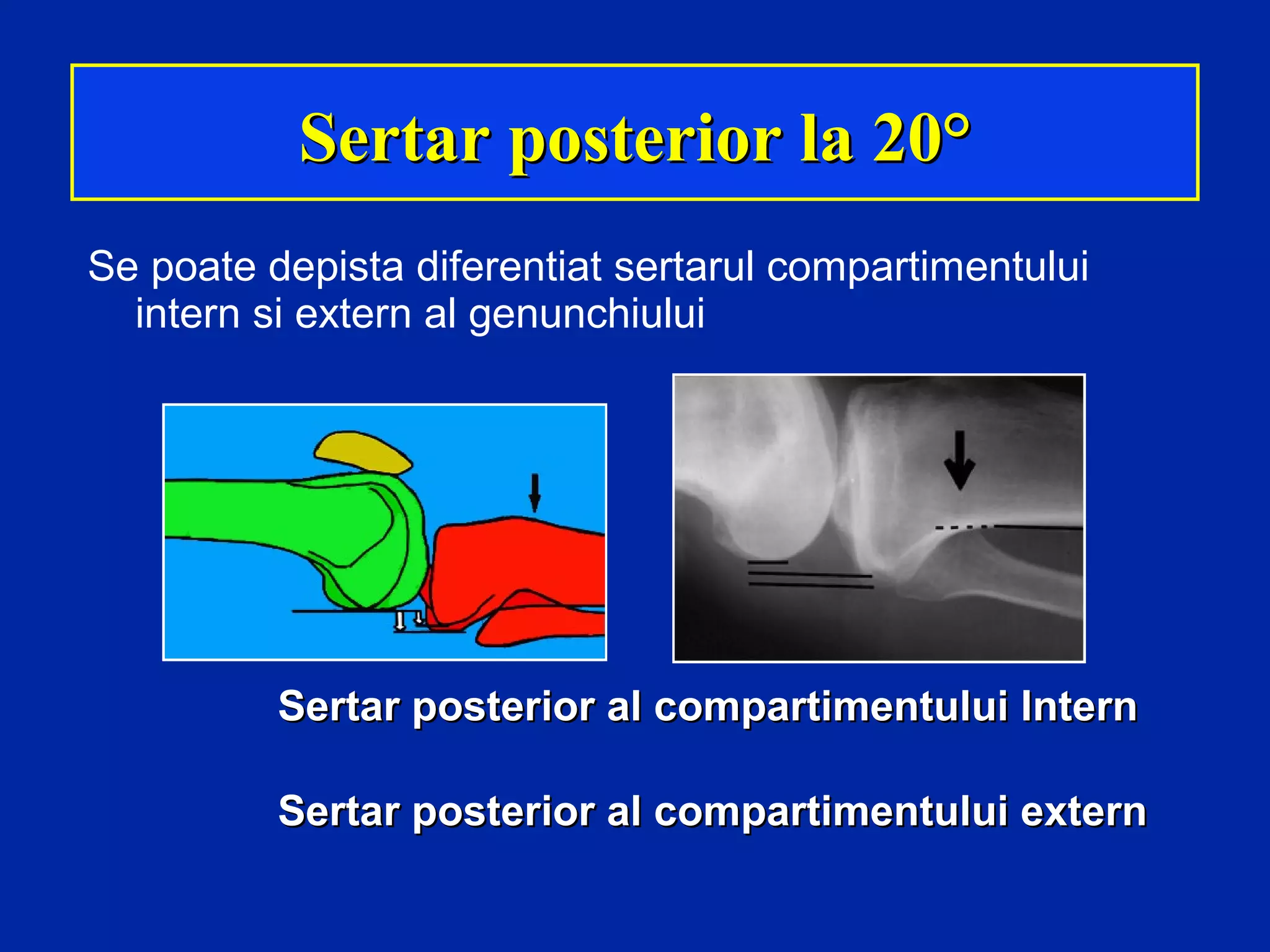 05 ligament incrucisat posterior | PPT