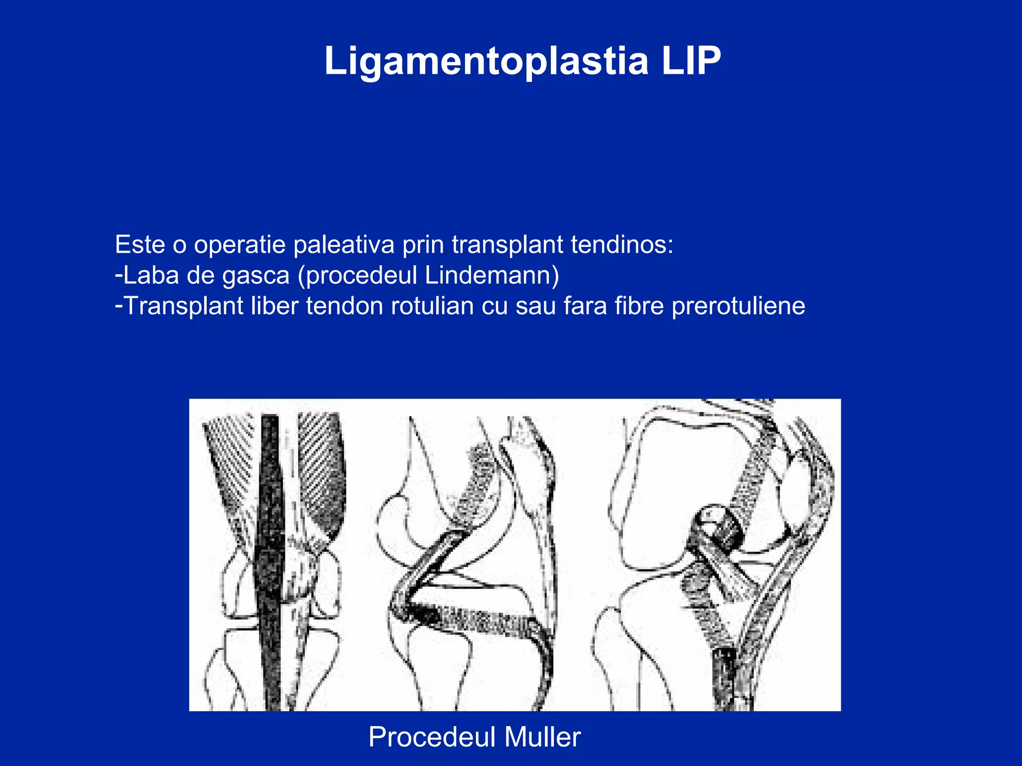 05 ligament incrucisat posterior | PPT