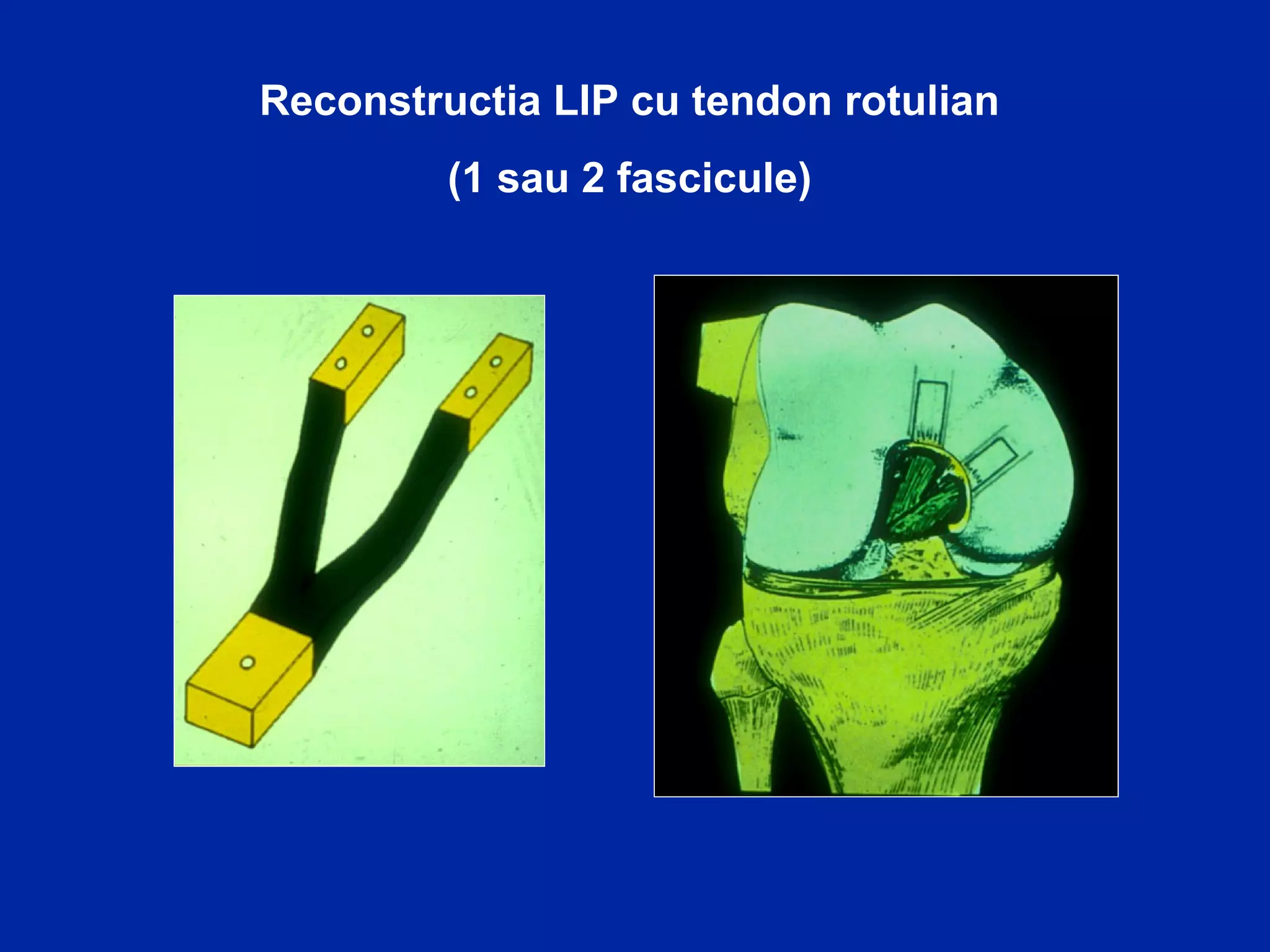 05 ligament incrucisat posterior | PPT