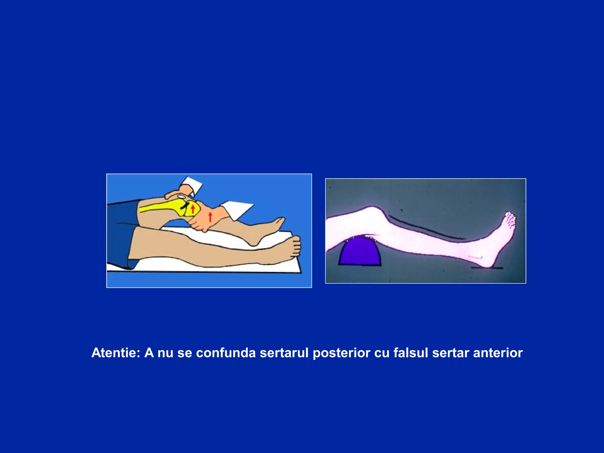 05 ligament incrucisat posterior | PPT