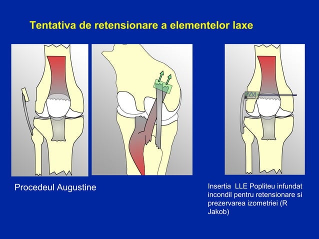 05 ligament incrucisat posterior | PPT