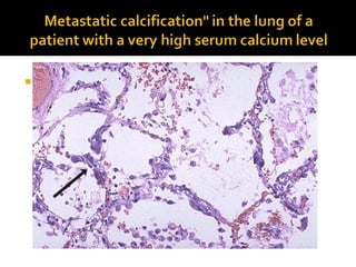05-PATHOLOGIC CALCIFICATION ggg 2008.ppt