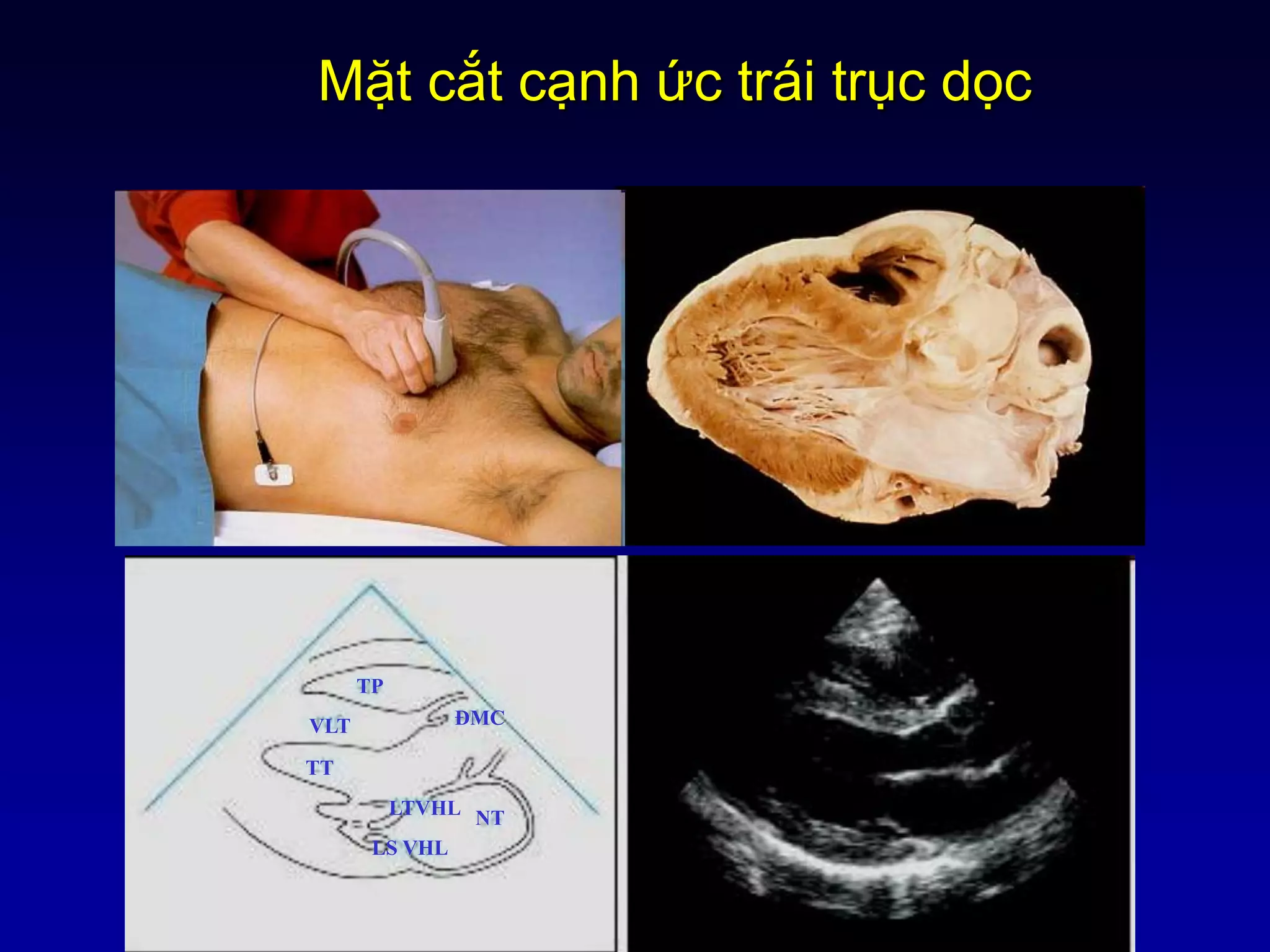 05. sieu am tim co ban | PDF