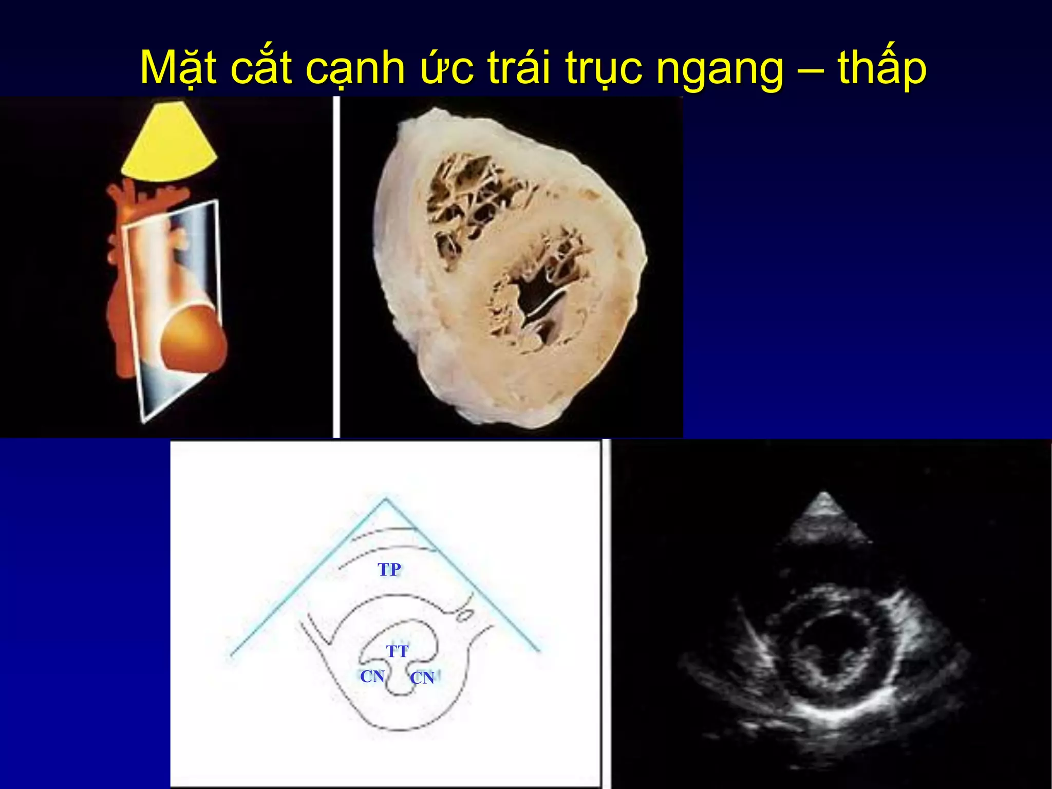 05. sieu am tim co ban | PDF