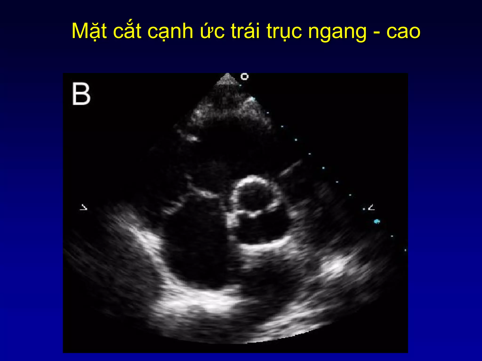 05. sieu am tim co ban | PDF