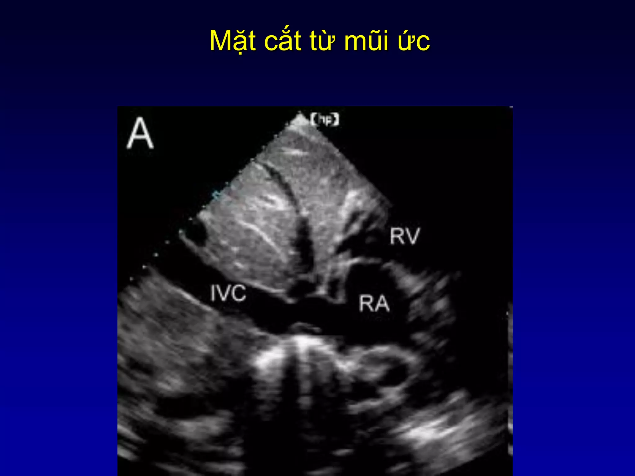 05. sieu am tim co ban | PDF