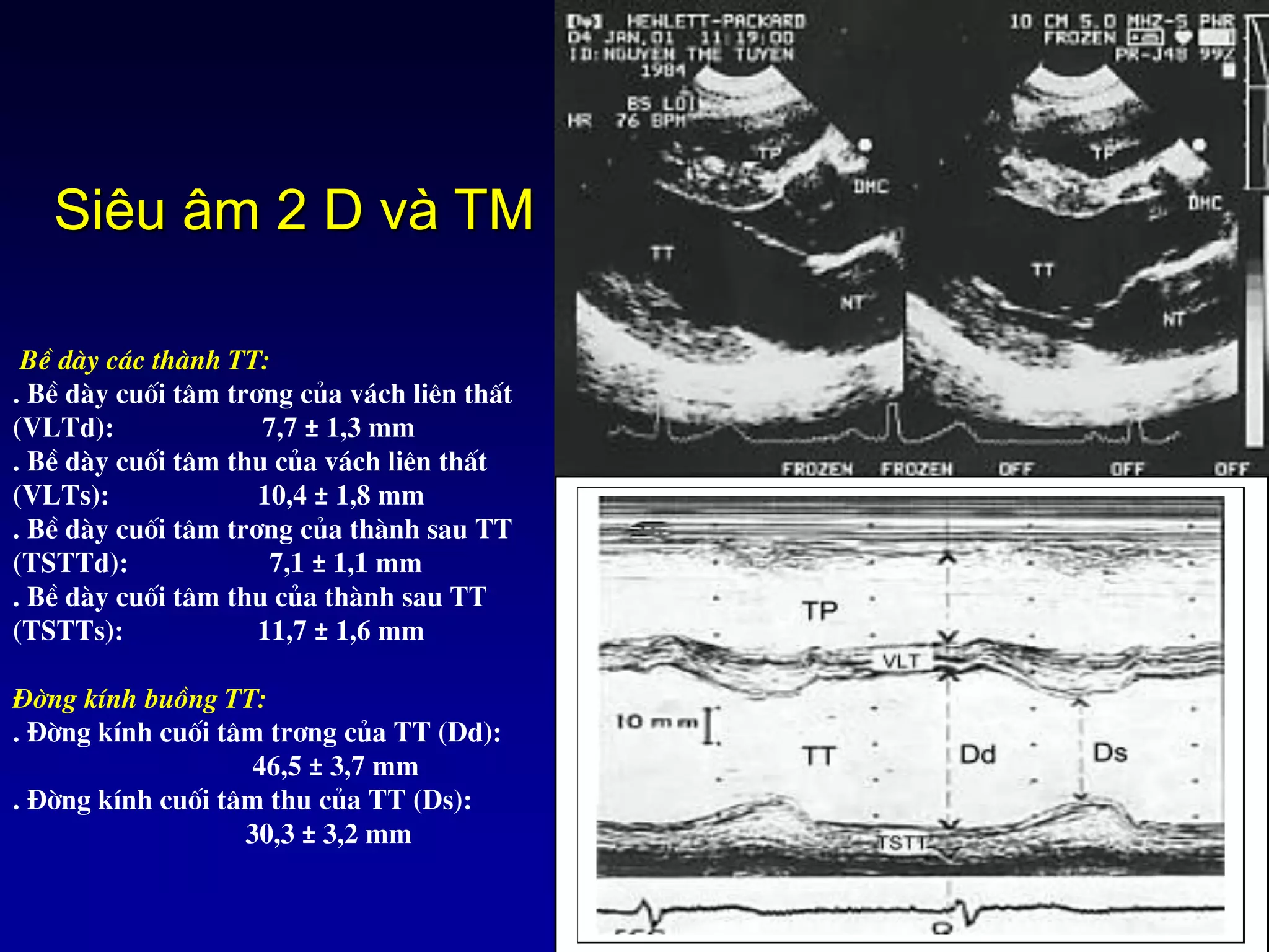05. sieu am tim co ban | PDF