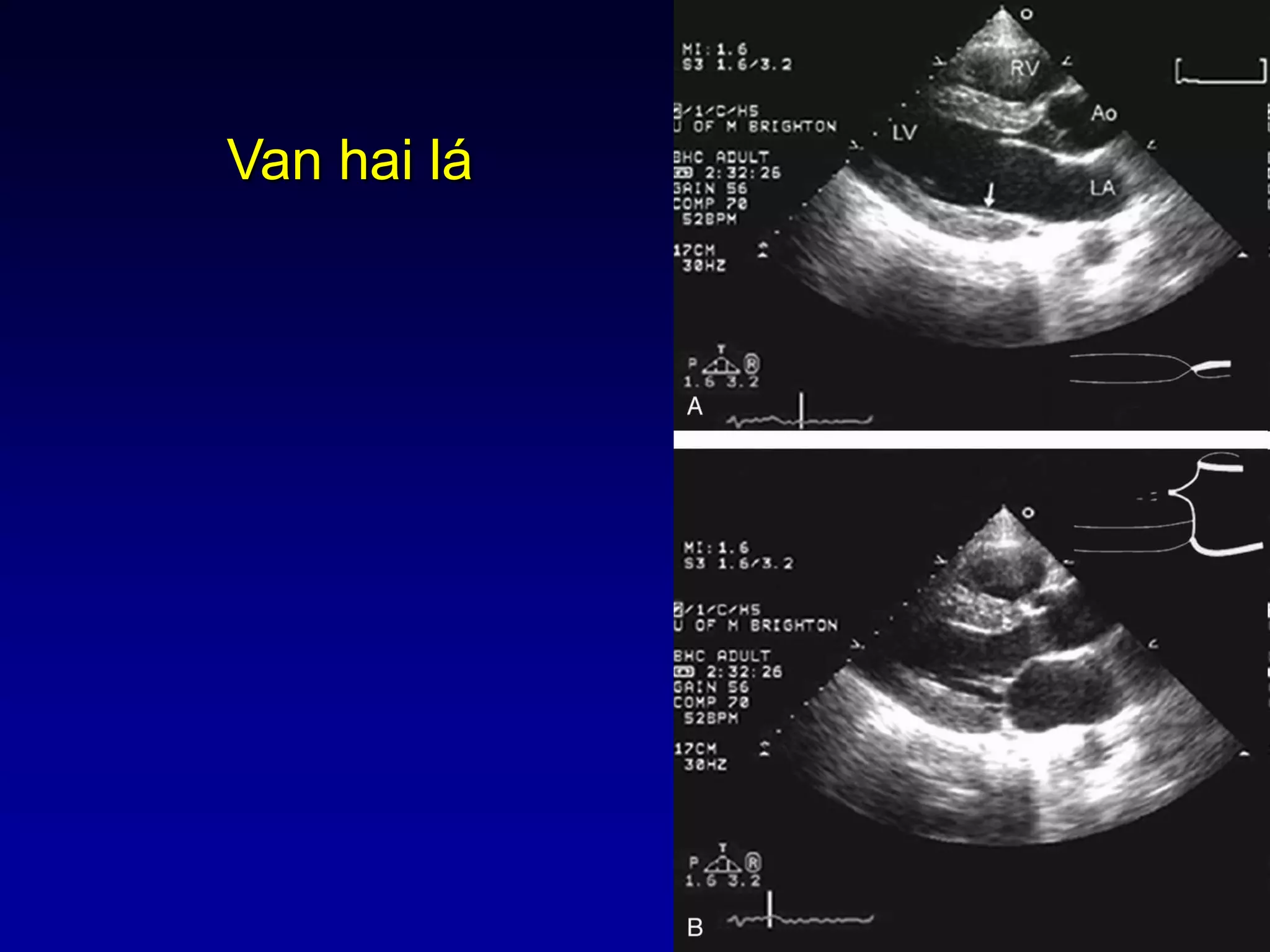 05. sieu am tim co ban | PDF