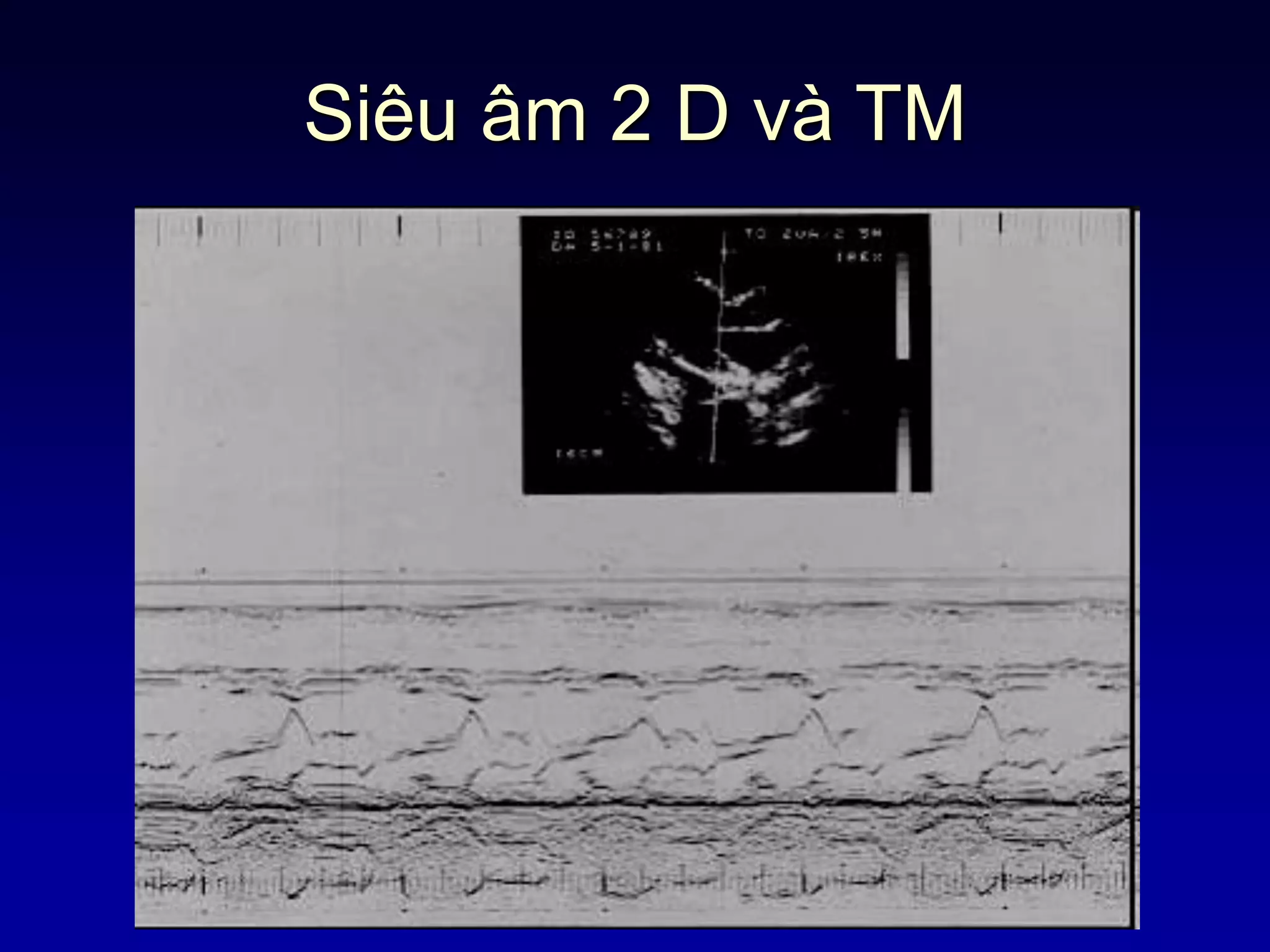 05. sieu am tim co ban | PDF