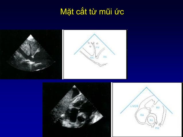 05. sieu am tim co ban | PDF