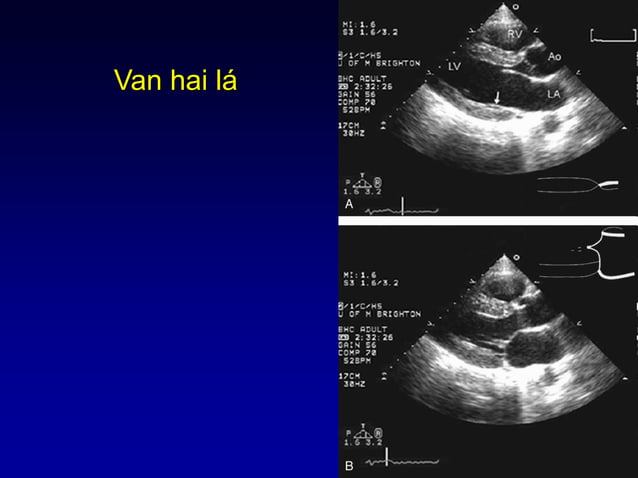 05. sieu am tim co ban | PDF