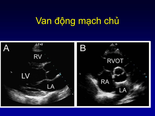 05. sieu am tim co ban | PDF