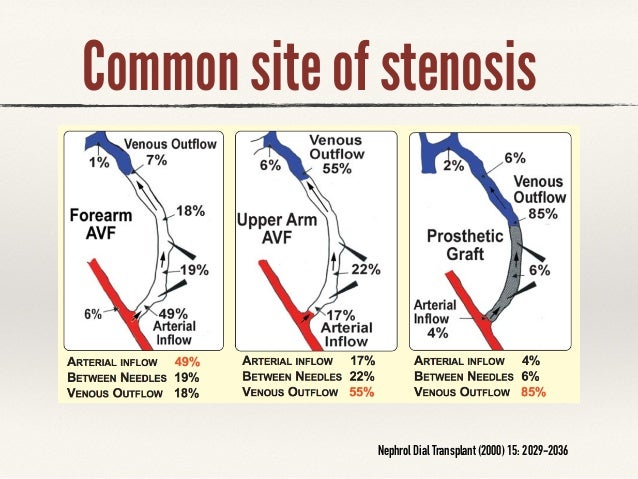 Vascular access in hemodialysis chaken 2018
