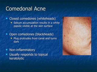 Acne | PPT