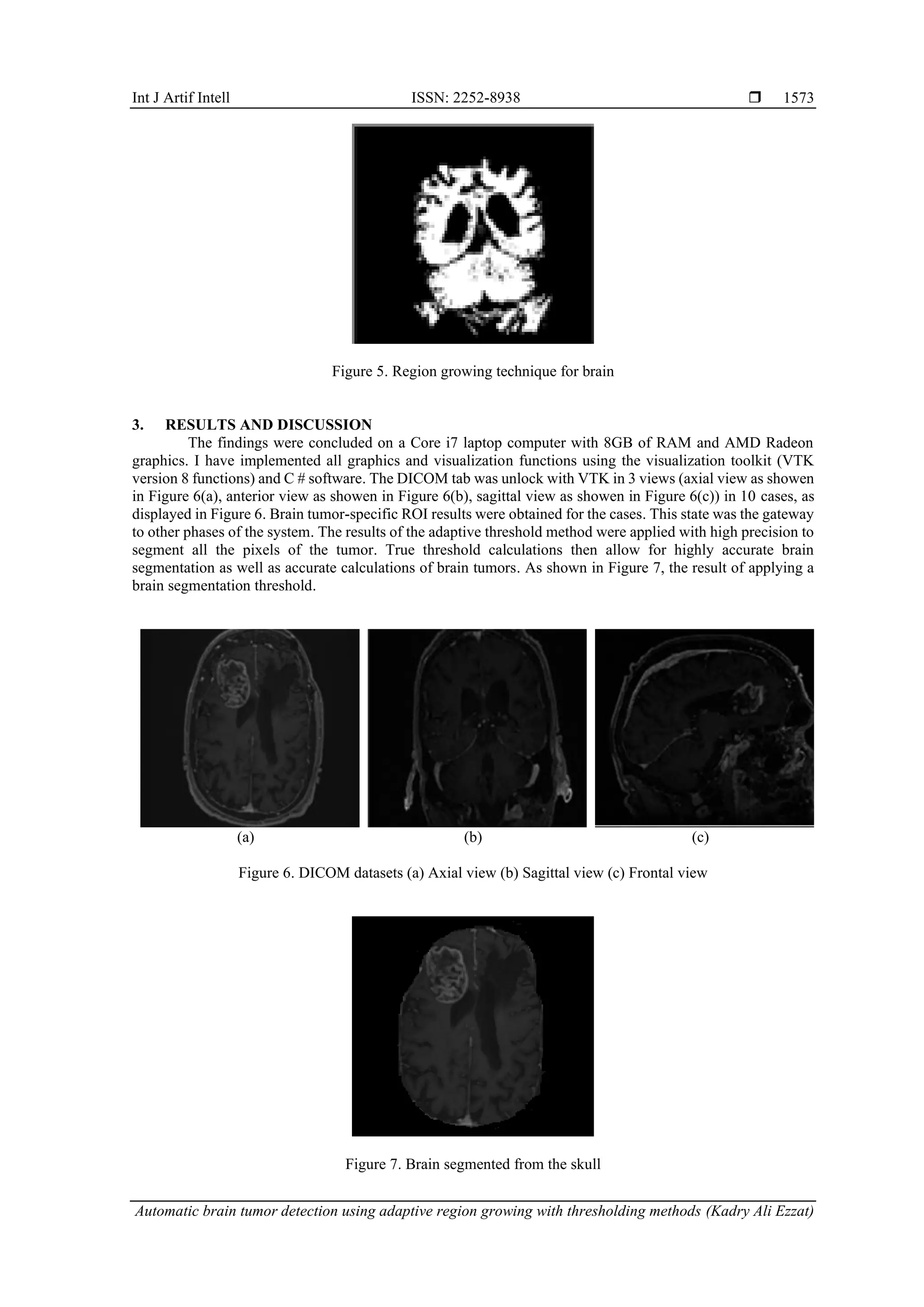 Automatic Brain Tumor Detection Using Adaptive Region Growing With