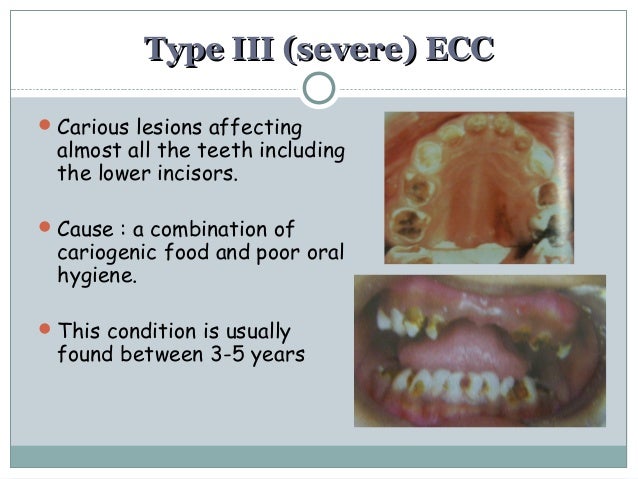 Early childhood caries (ECC)