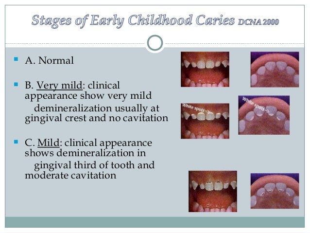 Early childhood caries (ECC)