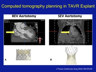 Transcatheter Aortic Valve (TAVR) Explant | PDF