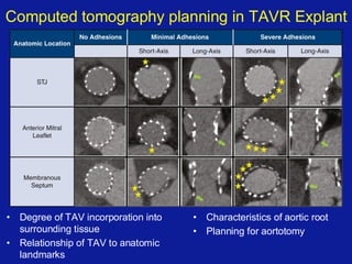 Transcatheter Aortic Valve (TAVR) Explant | PDF