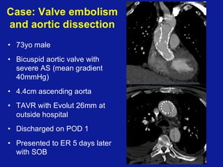 Transcatheter Aortic Valve (TAVR) Explant | PDF