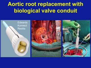 Transcatheter Aortic Valve (TAVR) Explant | PDF