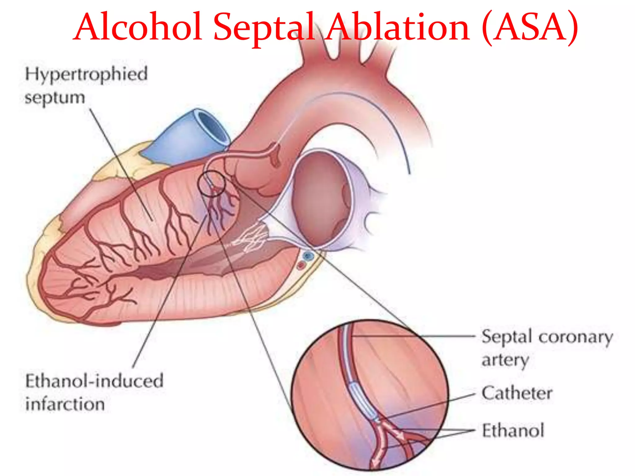 05 Alcohol Septal Ablation 5m.pptx