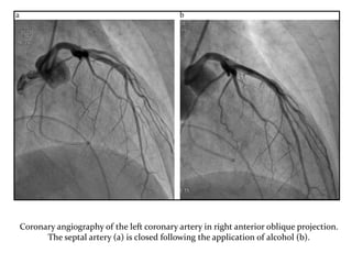05 Alcohol Septal Ablation 5m.pptx