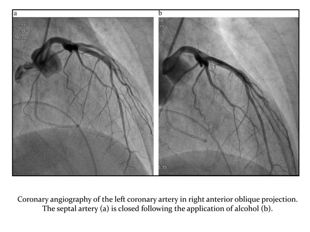 05 Alcohol Septal Ablation 5m.pptx | Heart and Cardiovascular Diseases ...