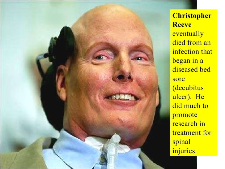 Christopher Reeves Pressure Ulcer