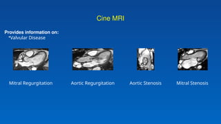 Vasodilator Cardiac MRI Stress Testing (Cardiac Imaging) | PPTX