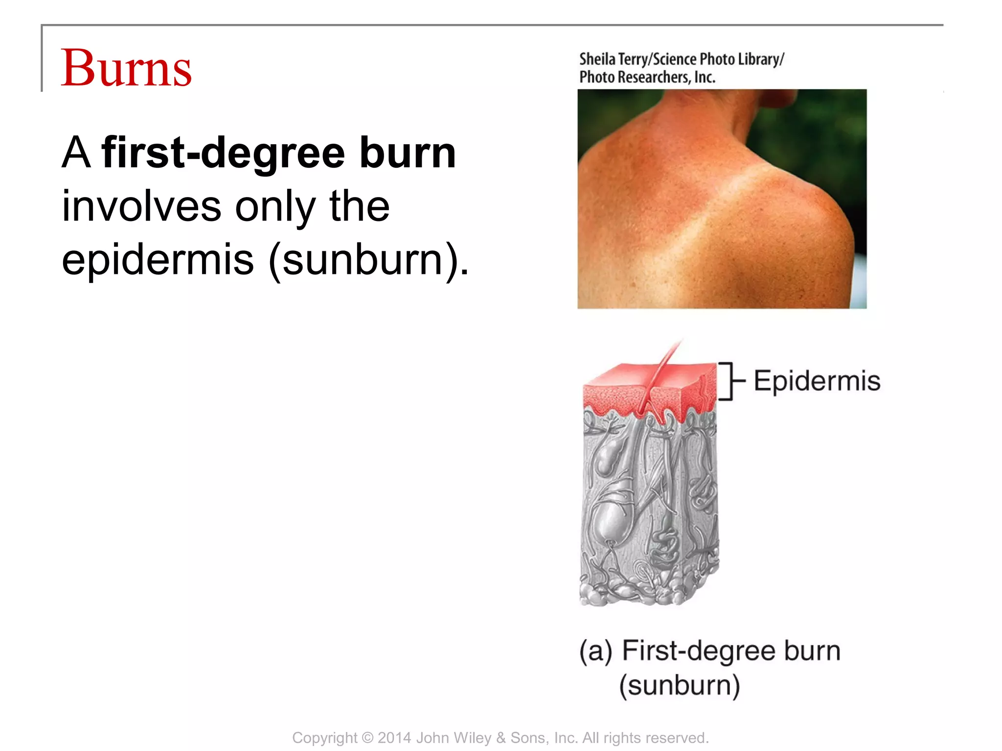 05 [chapter 5 the integumentary system] | PPT