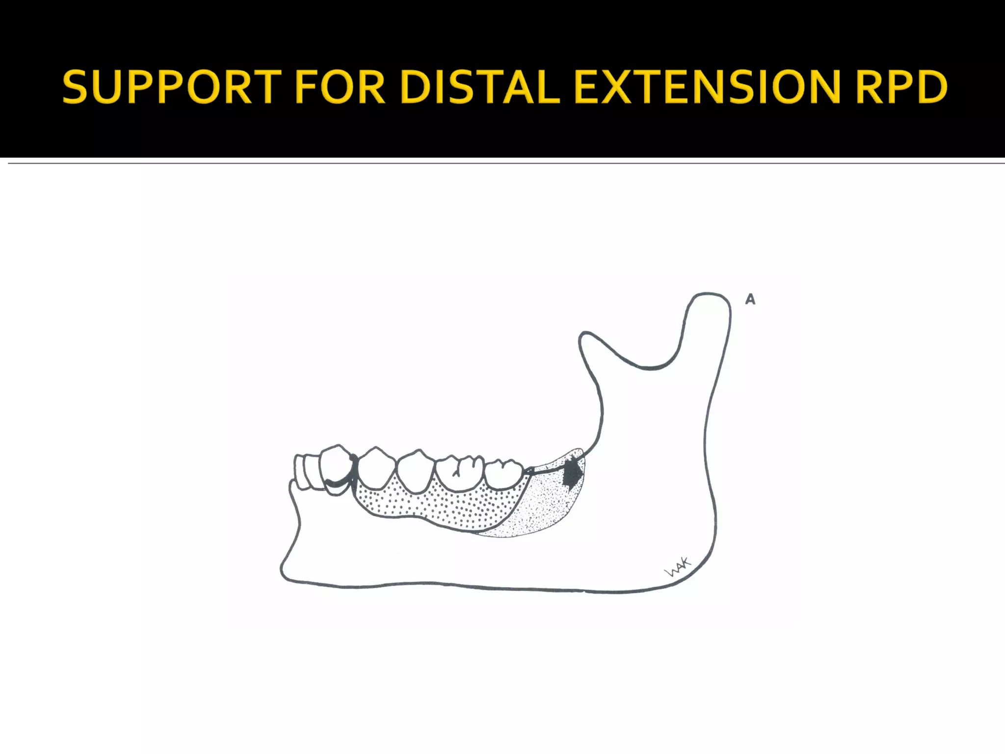 Direct retainers for Removable partial dentures | PPT