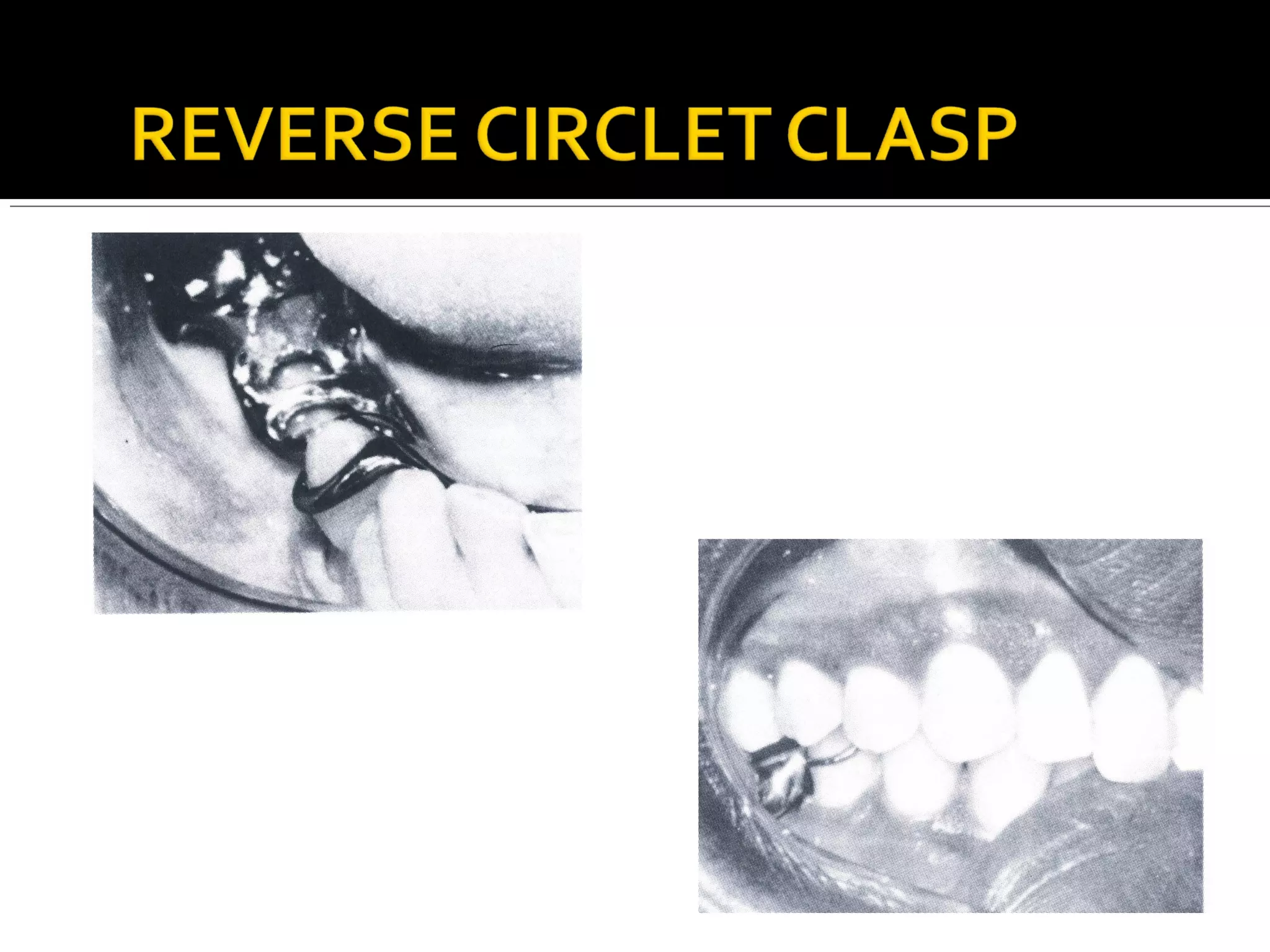 Direct retainers for Removable partial dentures | PPT