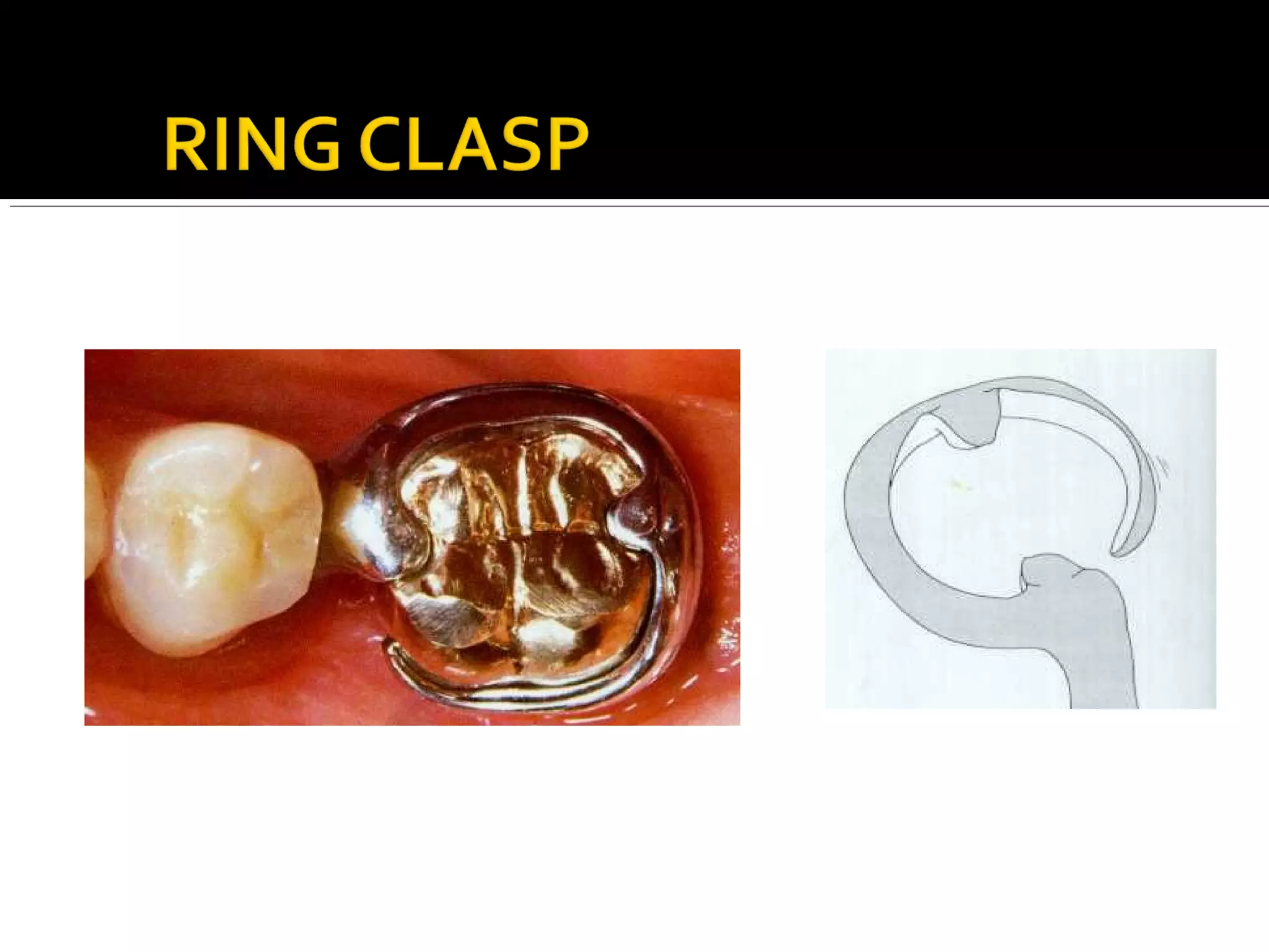 Direct retainers for Removable partial dentures | PPT