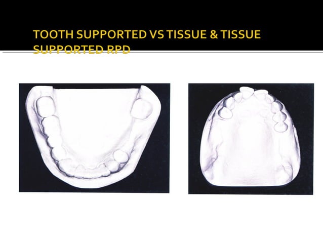 Direct retainers for Removable partial dentures | PPT