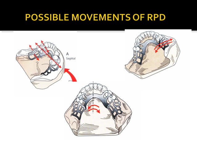 Direct retainers for Removable partial dentures | PPT