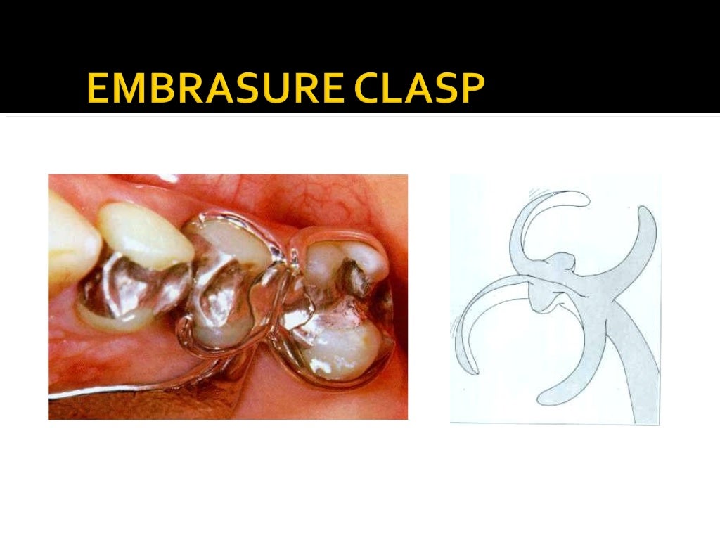 Direct retainers for Removable partial dentures