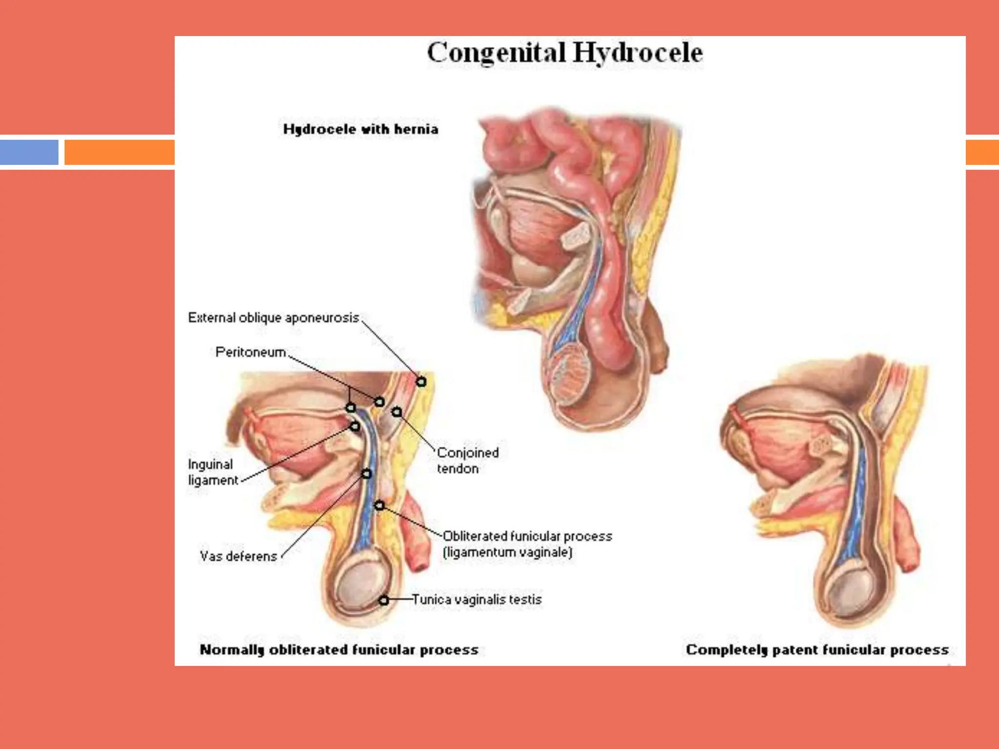 (05) HIL and Hydrocele management in children.ppt | Infertility | Reproductive Health