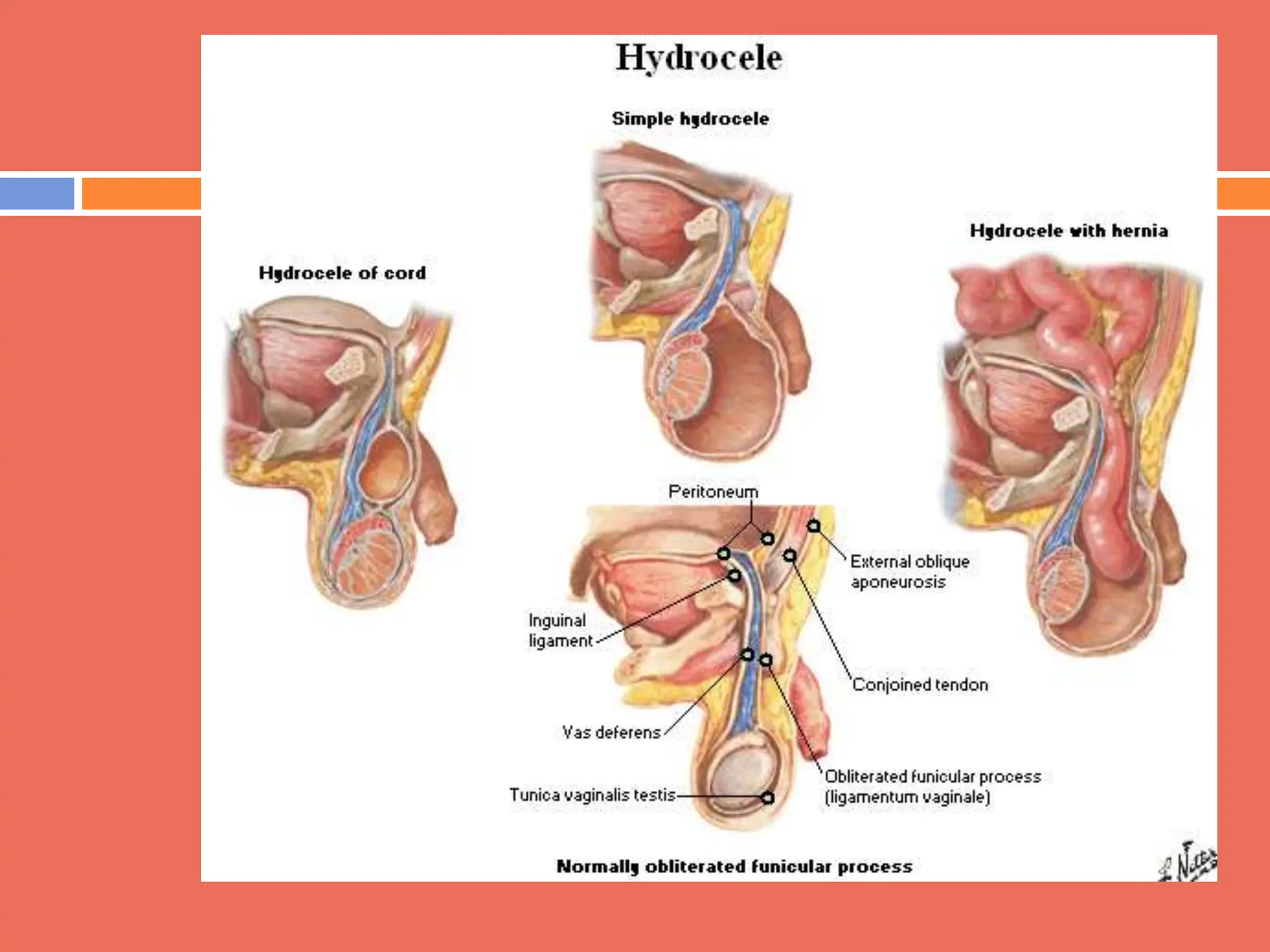 (05) HIL and Hydrocele management in children.ppt | Infertility | Reproductive Health