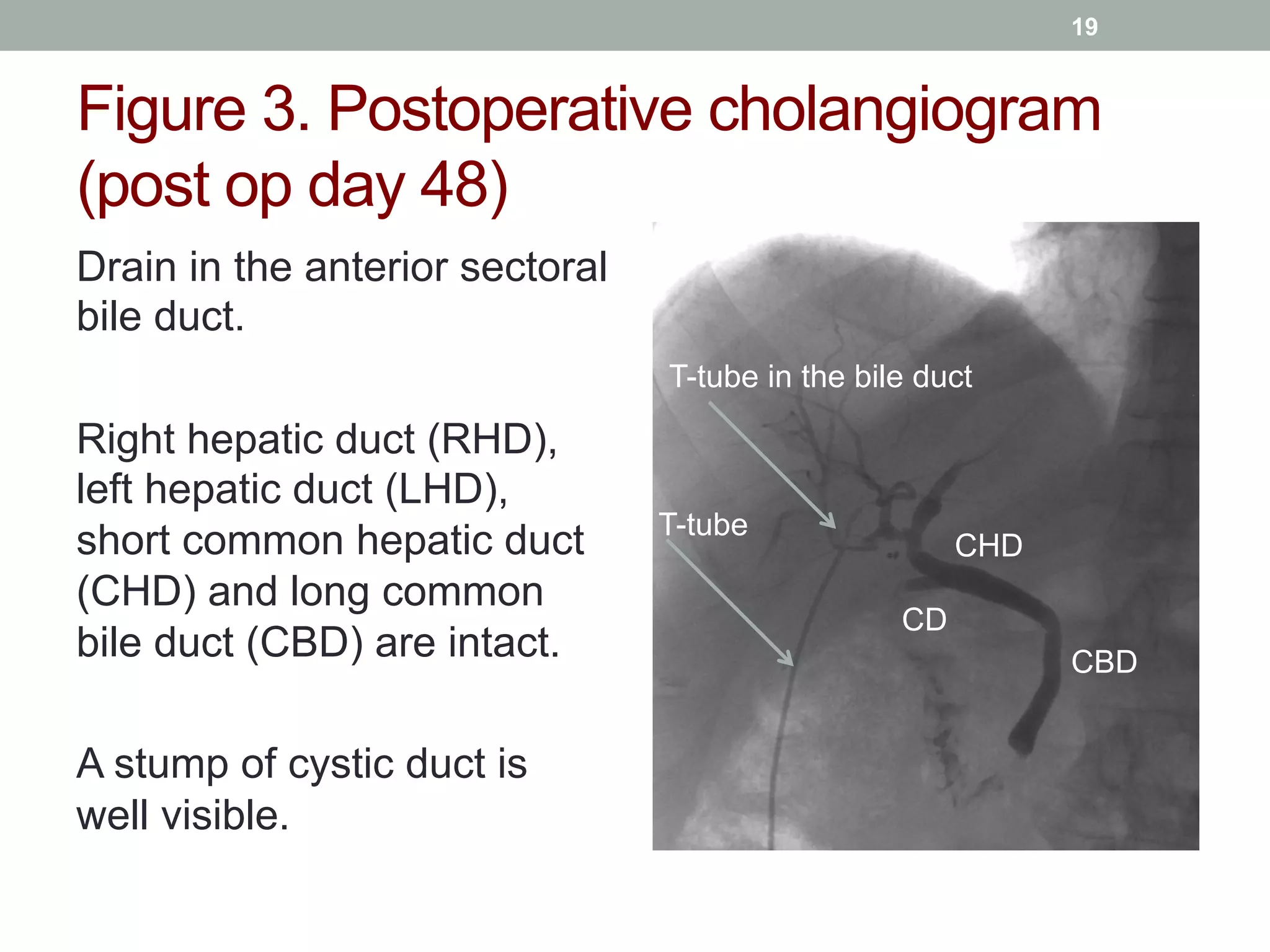 Laparoscopic cholecystectomy: complications, 2018, by R. Lunevicius | PPT