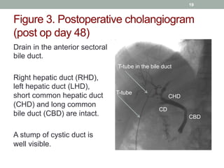 Laparoscopic cholecystectomy: complications, 2018, by R. Lunevicius | PPT