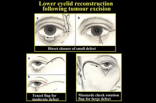 05 malignant eyelid tumours | PPT