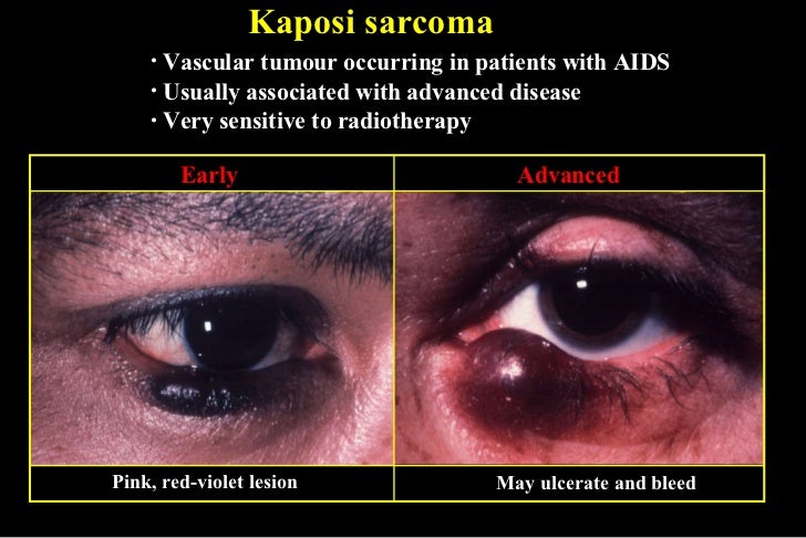 05 malignant eyelid tumours